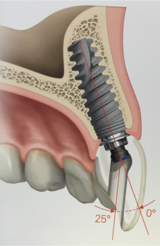 Houston Dental Lab - Miracle Dental Lab - Dental Implants